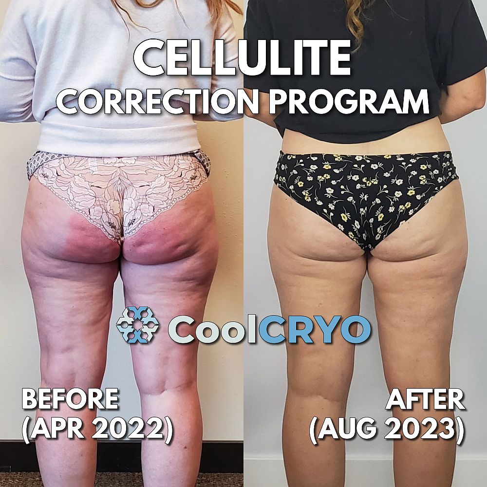 Before & After Photos | CoolCRYO